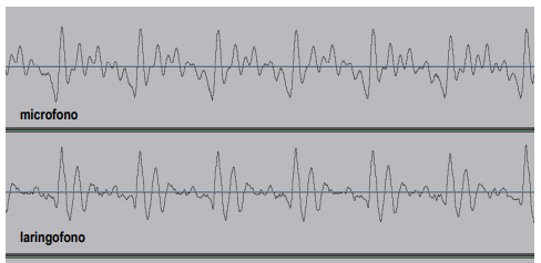 Laringe artificiale - Искусственная гортань - Artificial larynx ...