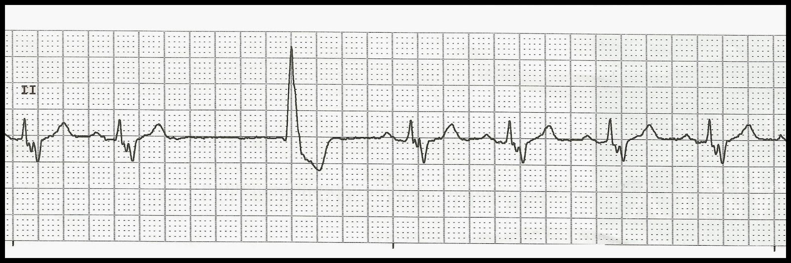 Basic EKG Rhythm Test Final Exam 2013