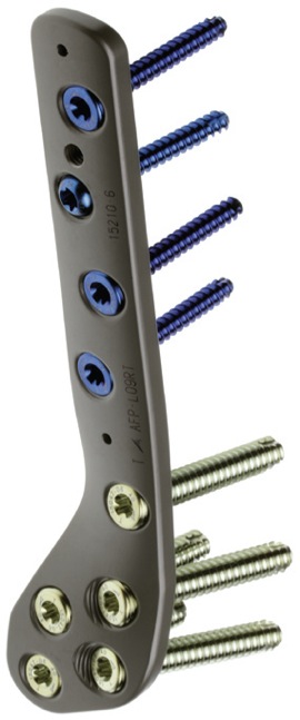 The Daily Fix: New Ascension Ankle Fusion Plate