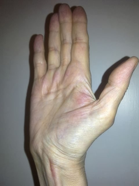 Wrist in plaster cast or finger injury - how to remove stiffness or ...