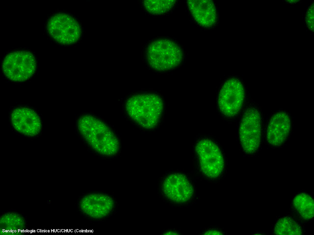 Anticorpos anti - Sm e anti - RNP