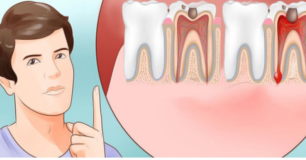Tooth Abscess: 10 Home Remedies to Help Manage the Infection - Health ...