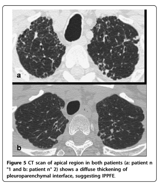 内科開業医のお勉強日記: Pleuroparenchymal fibroelastosis (PPFE) with UIP は、IPF/UIP ...