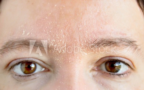 Skincare For Dry Flaky Skin On Face | Sanisha14