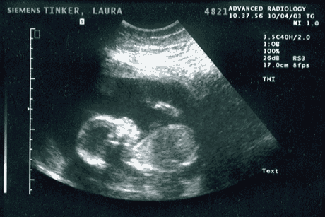 What is Ultrasound? | Facts About All