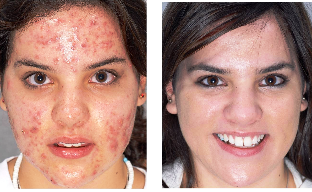 TIMES UPDATE MESSAGE FOR ALL DANGERS INHERENT IN SQUEEZING PIMPLES times-update-message-for-all-dangers-inherent-in-squeezing-pimples