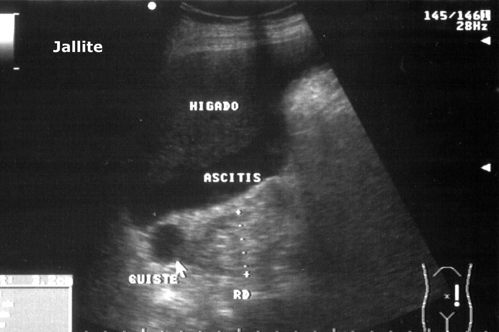 Hernia Umbilical y......