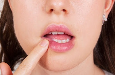 Afta: o que é, como tratar e prevenir o problema - Portal Telenotícias