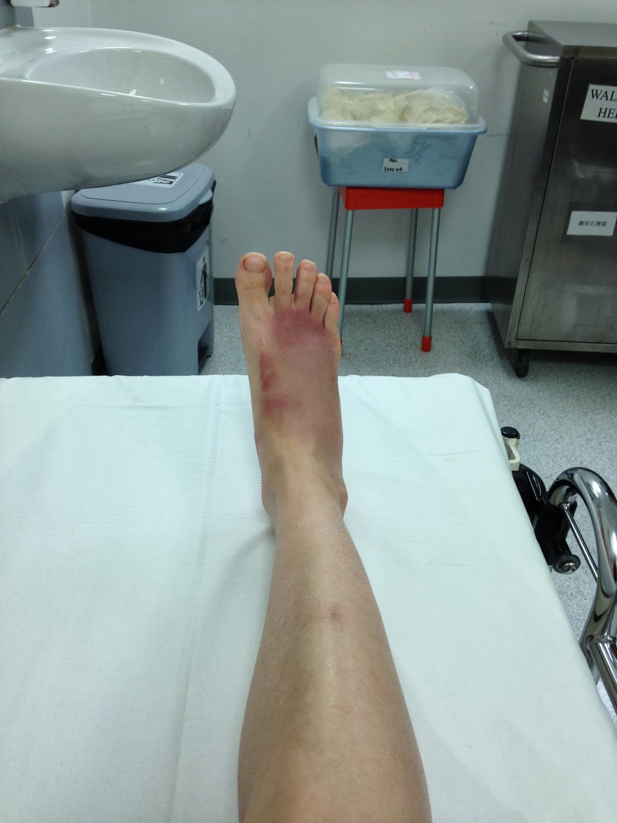 右腳掌骨裂 Right Foot Injury With Fracture: 拗柴第二天 Day 2 after injuried