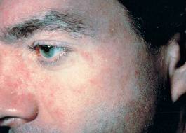 La dermatite séborrhéique peut