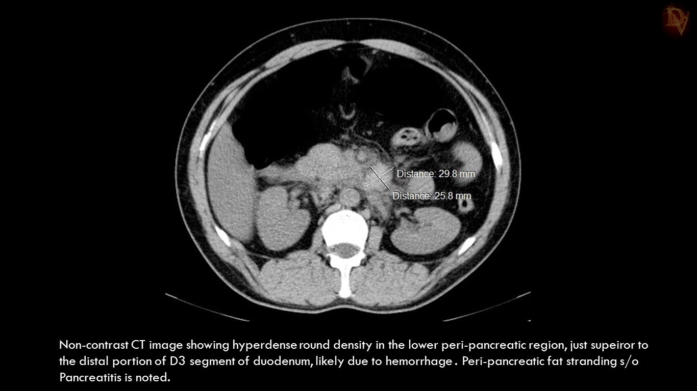 Ultimate Radiology : Acute Pancreatitis with hemorrhage and Pancreas ...