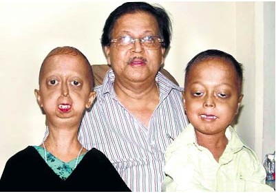 progeria cases in india ~ Christine O'Donnell