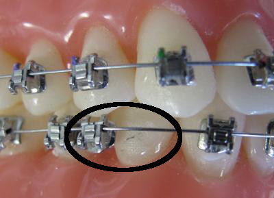 Dr. Dante Gonzales' Blog: Why Do Braces Break, and What Should I Do?