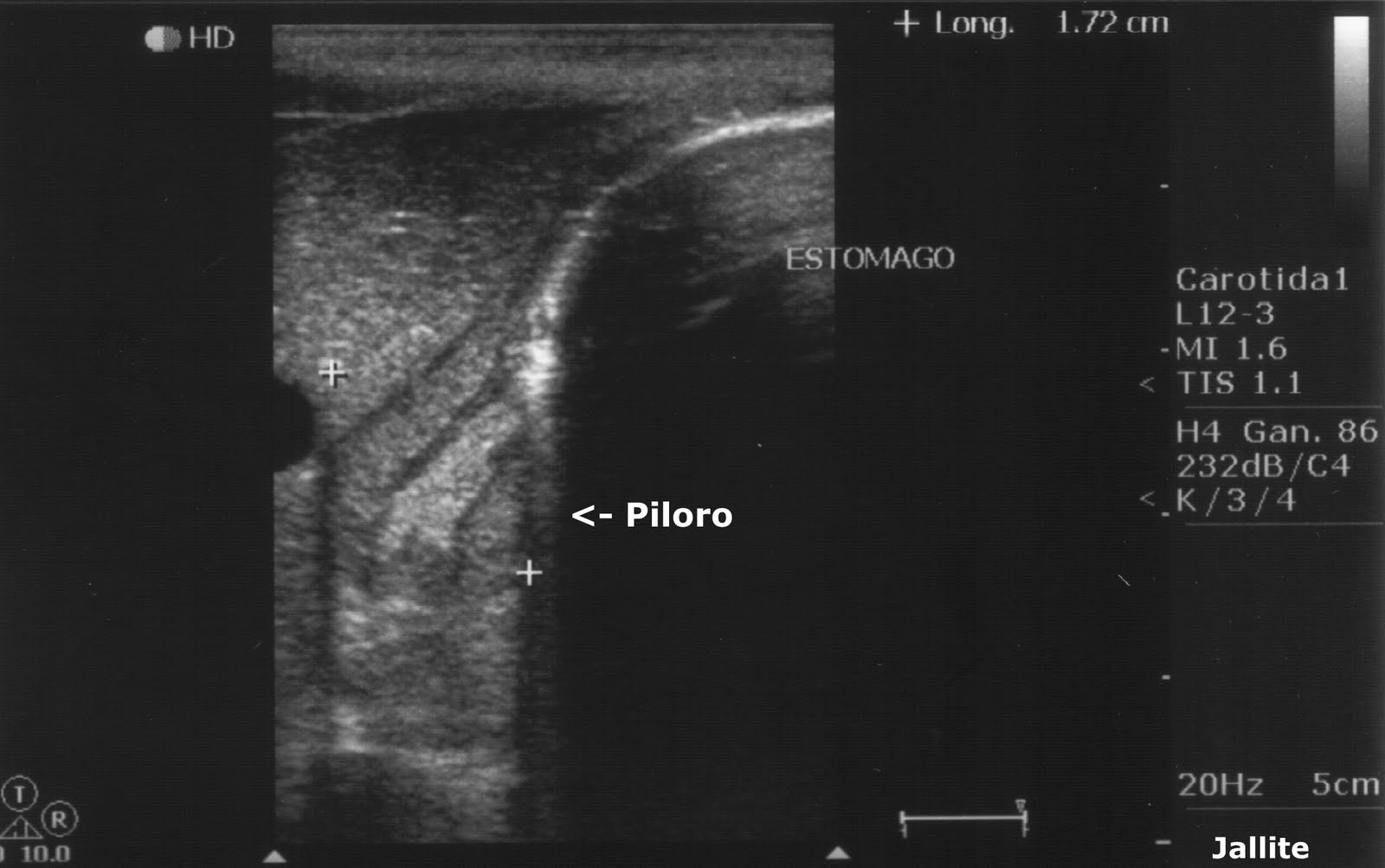 Estenosis Hipertrofica Piloro