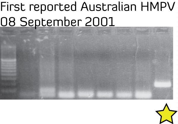 VDU's blog: A primer on human metapneumovirus (hMPV)...