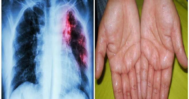 Ciri Penyakit Paru Paru Basah - Perumperindo.co.id