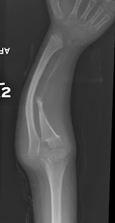 Pseudarthrosis of the Forearm | Congenital Hand and Arm Differences ...