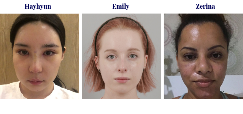 ID Hospital Korea: Recovery process for rhinoplasty in korea