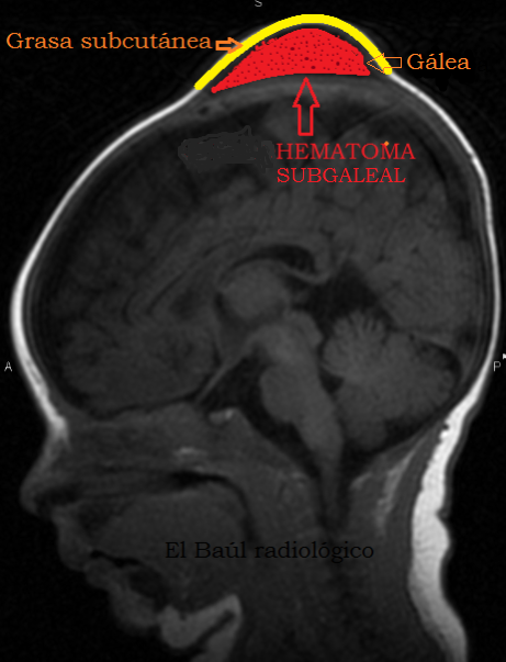 El Baúl Radiológico: 2) HEMATOMA SUBGALEAL: HALLAZGOS EN TOMOGRAFÍA ...