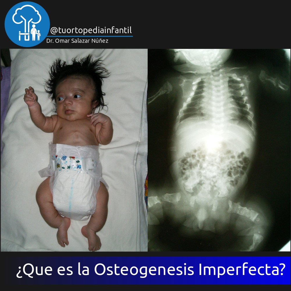 ¿Que es la Osteogénesis Imperfecta?