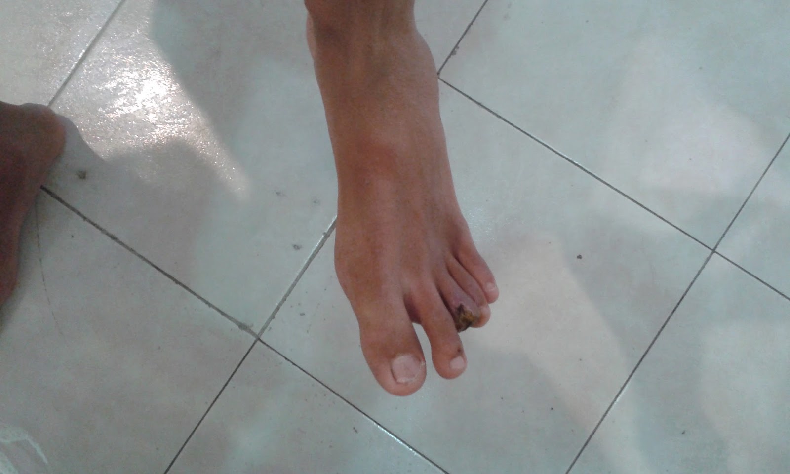 budak bakong: Putus Jari Kaki kena pembahagi jalan@tuntutan PERKESO/SOCSO