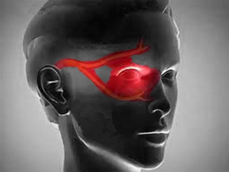 OJO ALÉRGICO, SECO GRAVE Y SJÖGREN: DOLOR OCULAR: SÍNDROME DE SUDECK