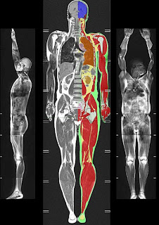 What can an MRI detect | MRI brain scan