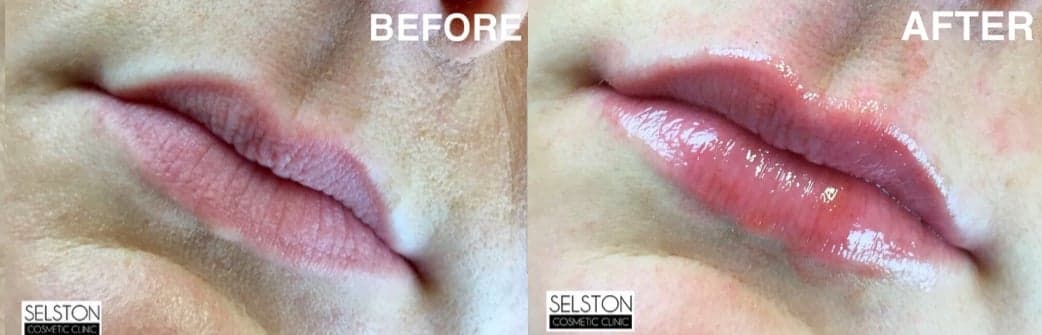 Selston Cosmetic Clinic: Add Volume With Lip Filler Treatment at ...