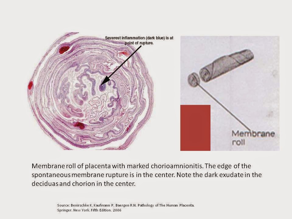Reza Aditya Digambiro: Chorioamnionitis