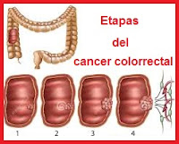 ENFERMEDADES INTESTINALES: ETAPAS DEL CÁNCER COLORRECTAL
