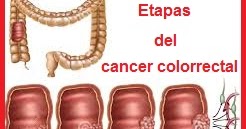 ENFERMEDADES INTESTINALES: ETAPAS DEL CÁNCER COLORRECTAL