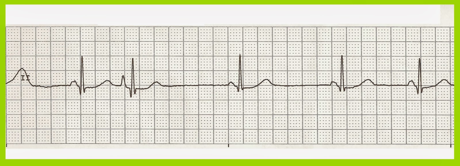 Practice EKG Rhythm Strips 216