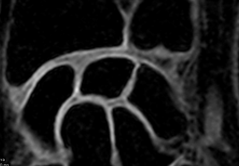 TRIANGULAR FIBROCARTILAGE COMPLEX- MRI - Sumer's Radiology Blog
