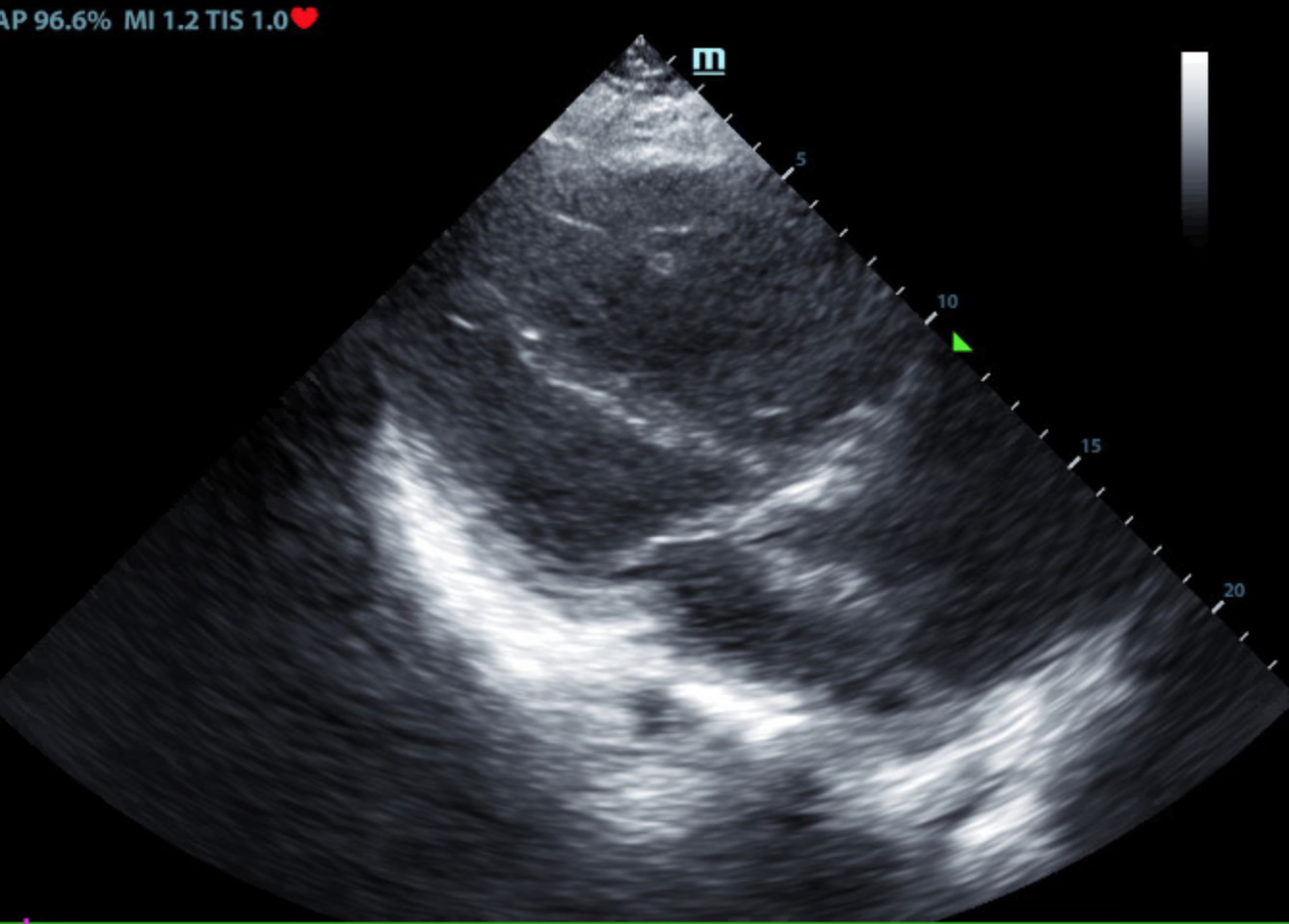 Dr. Smith's ECG Blog: Right sided heart failure and tachycardia.