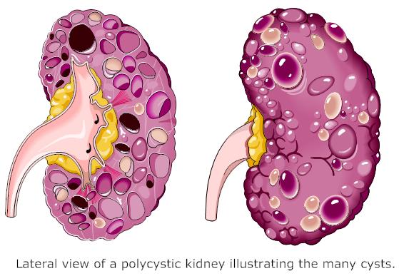 Easy Nephrology: Extrarenal manifestations of Autosomal Dominant ...