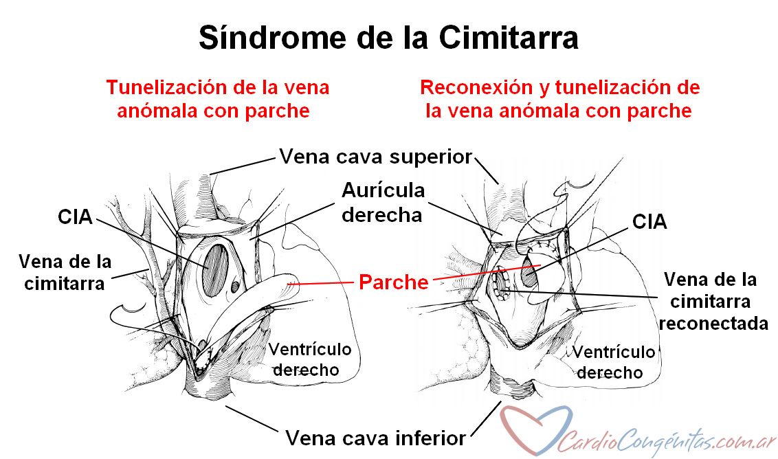 Enfermedades raras, más frecuentes de lo que imagináis: Síndrome de ...
