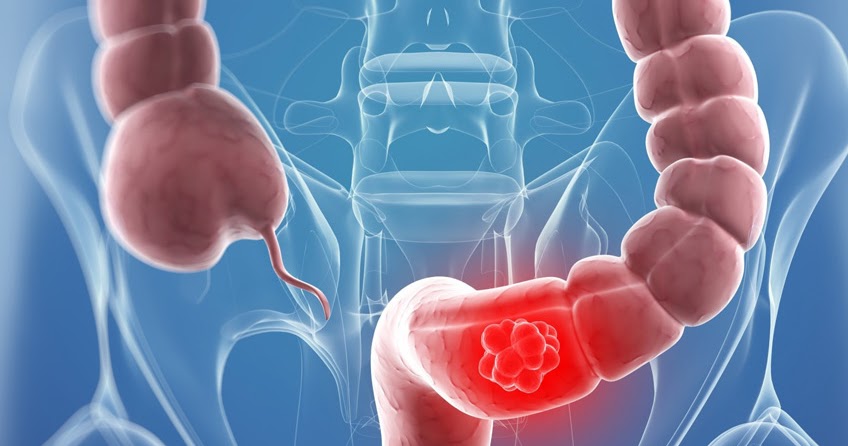 Signos y síntomas del cáncer de colón y ano