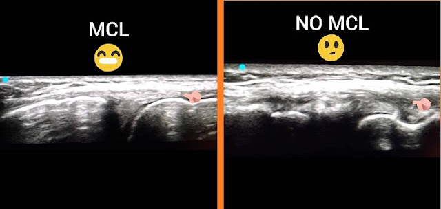 Medial Collateral Ligament Tear