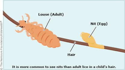 Realistic Idealist: Head Lice Advice