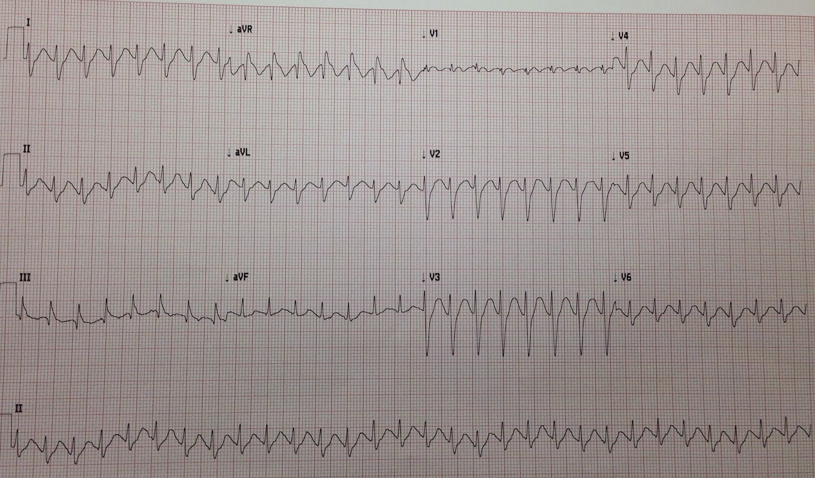 Dr. Smith's ECG Blog: A Relatively Narrow Complex Tachycardia at a Rate ...