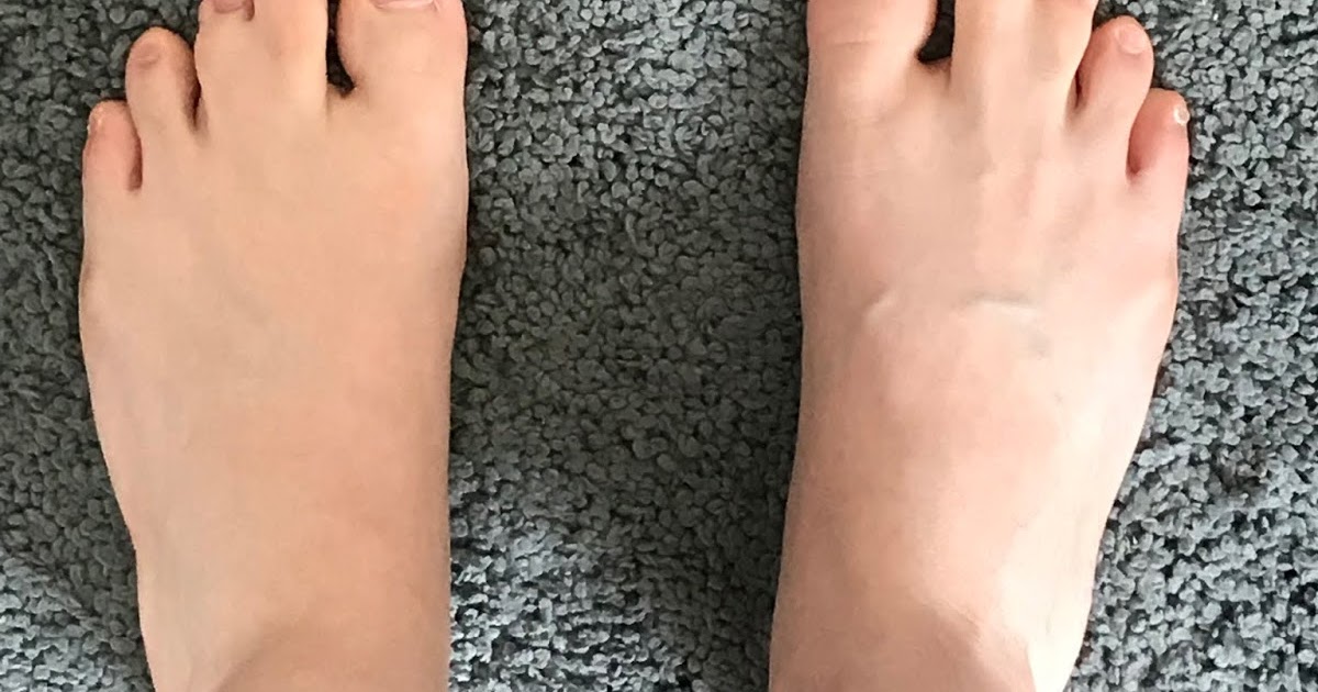 Toes syndactyly surgery recovery