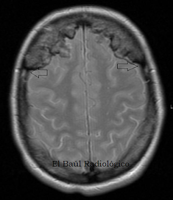 El Baúl Radiológico: HIPEROSTOSIS ENDOCRANEAL IDIOPÁTICA (Hiperostosis ...