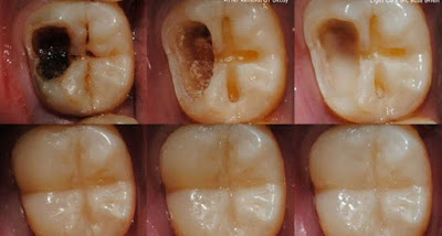 5 Tips On How to Reverse Cavities And Heal Tooth Decay Naturally