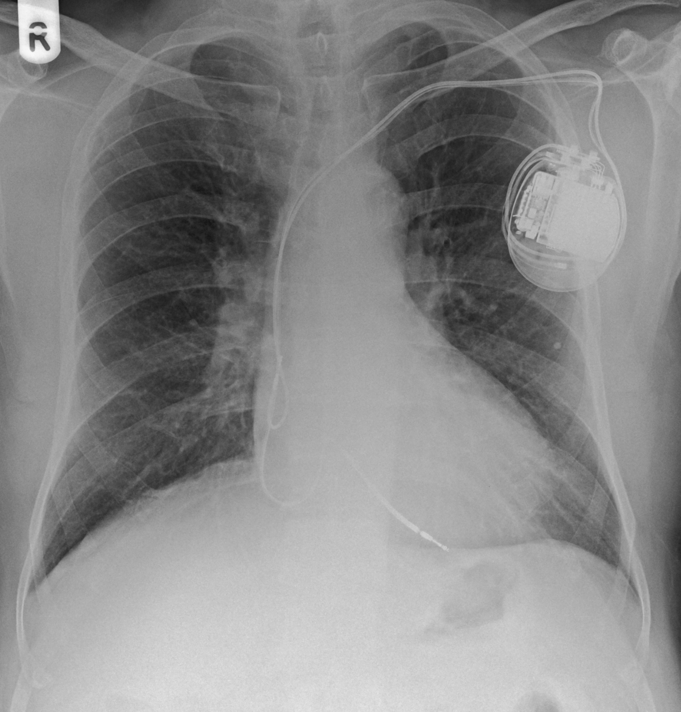 Cuidados com pacemaker - Procuro + Saúde