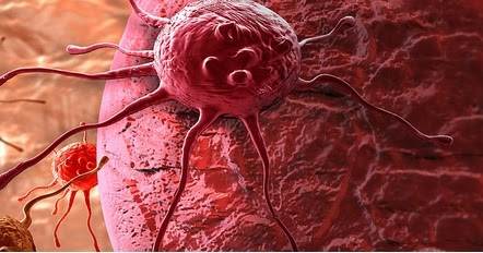 Pengertian Kanker, Jenis, Gejala dan Pencegahannya