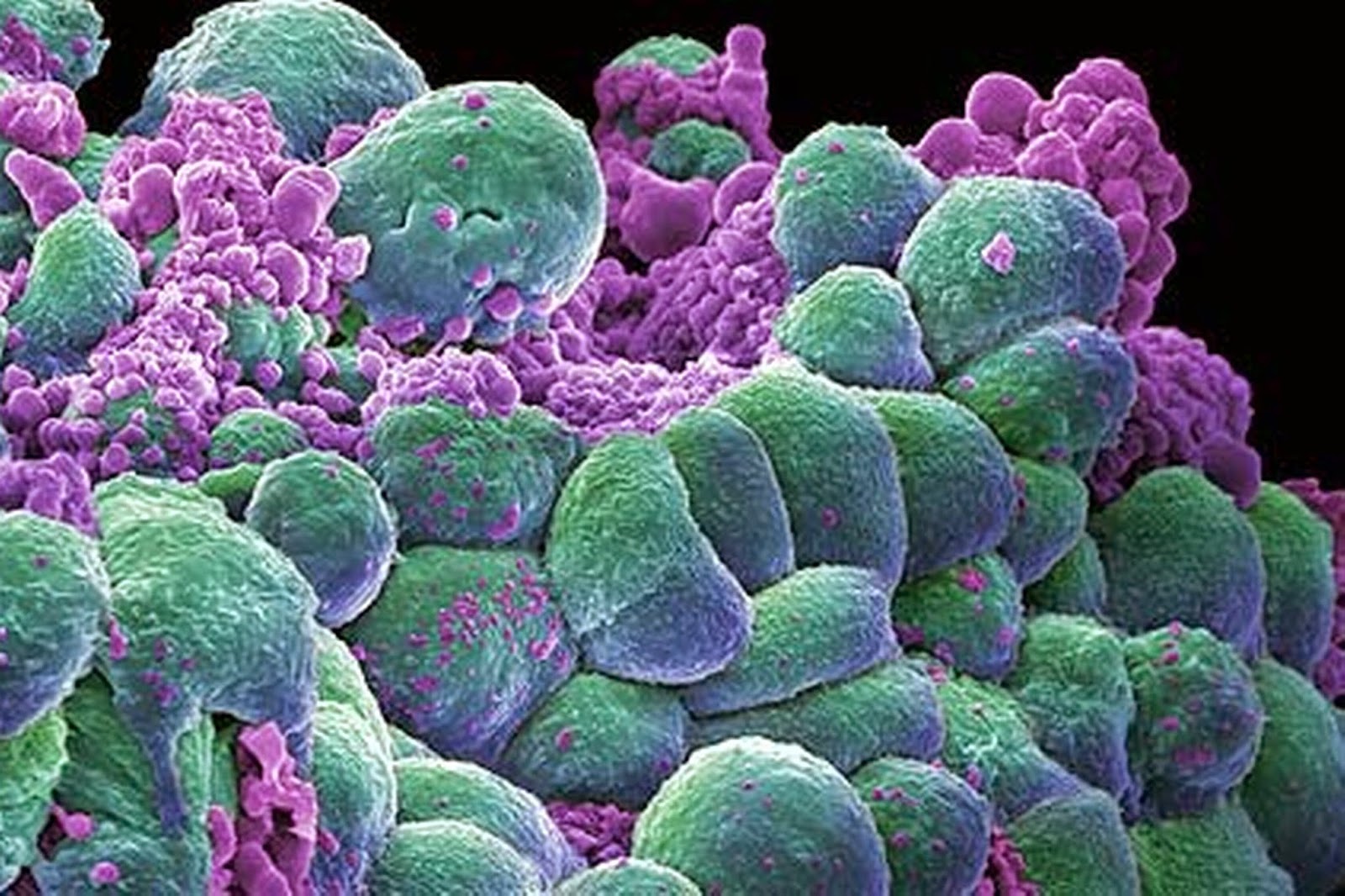 Fitness And Health Wiki: The Killer Cancer Cells