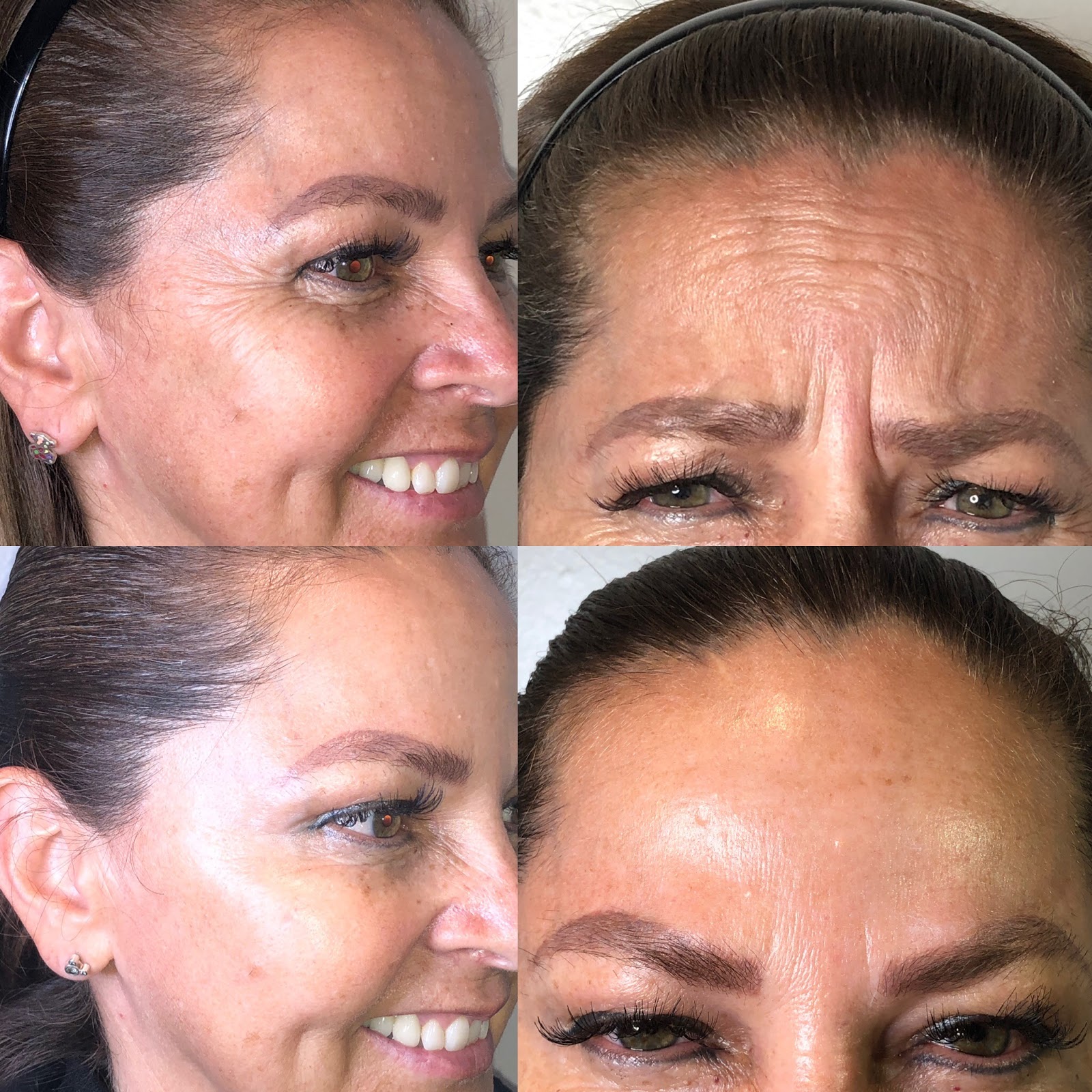 REPORTAJE HIPERACTIVO: MITOS Y VERDADES DEL BOTOX, EL TRATAMIENTO ...