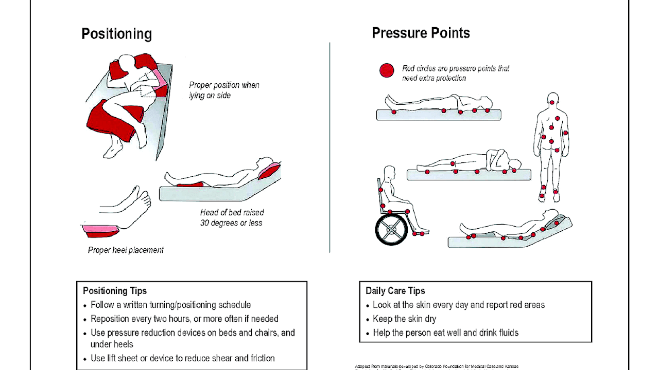 Heel Pressure Ulcers - Ulcer Choices