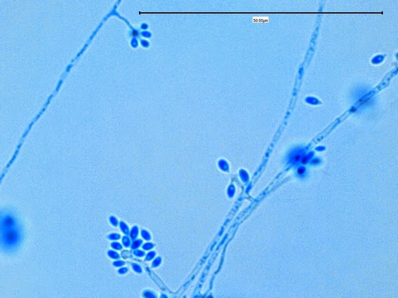 Fun With Microbiology (What's Buggin' You?): Sporothrix schenckii ...