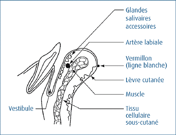 le maillon faible : stomatologie: Carcinomes des lèvres